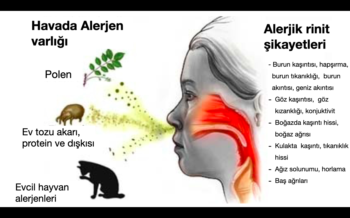 Alerjik rinit nedir? Ameliyat ile tedavisi mümkün müdür? – Doç. Dr ...